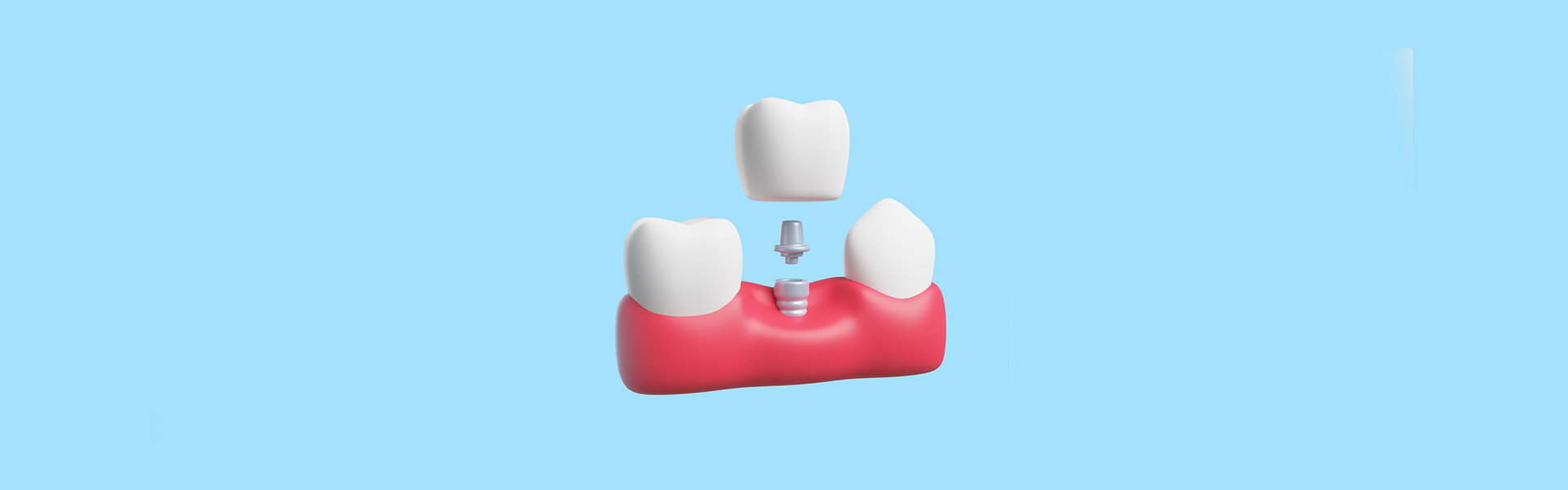 How Strong Are Dental Implants Compared To a Real Teeth?